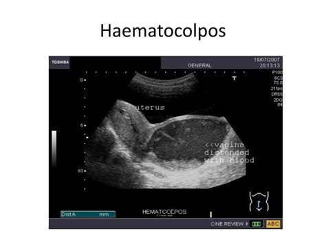 Ppt Pelvic Masses And Ovarian Cancer Powerpoint Presentation Free