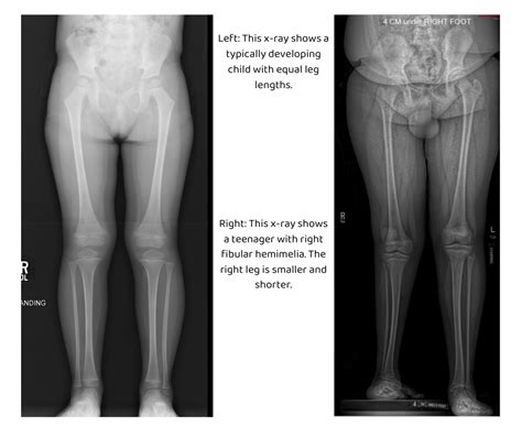 Fibular Hemimelia Or Fibular Deficiency