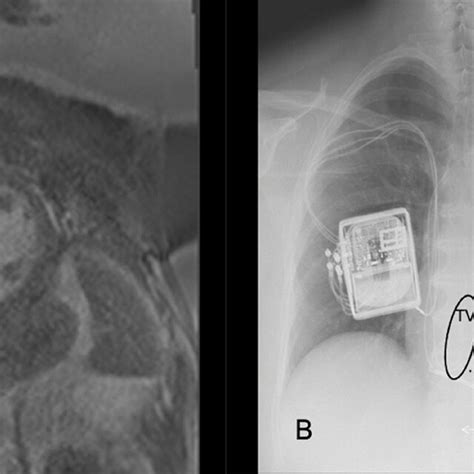Ccm Implantation And Placement Of Leads According To Aha Segment Model Download Scientific