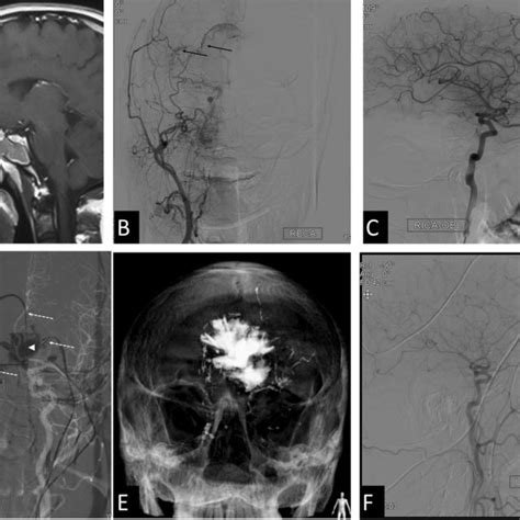 Avm Classification By Yakes Et Al 9 Download Scientific Diagram