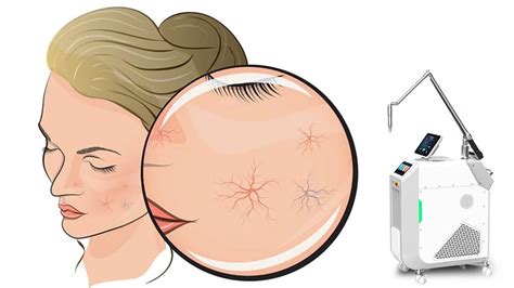 Laser Treatment Eliminates Spider Veins Rheinlaser ️