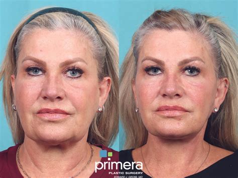 Mini Facelift Before And After Pictures Case 904 Orlando Winter Park