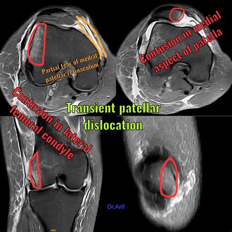 Medial Patellar Retinaculum Mri