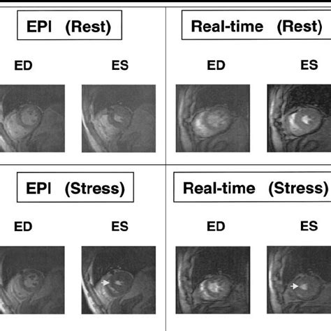Diagram Shows A Segment Model Of The Left Ventricle Short Axis View Of Download Scientific