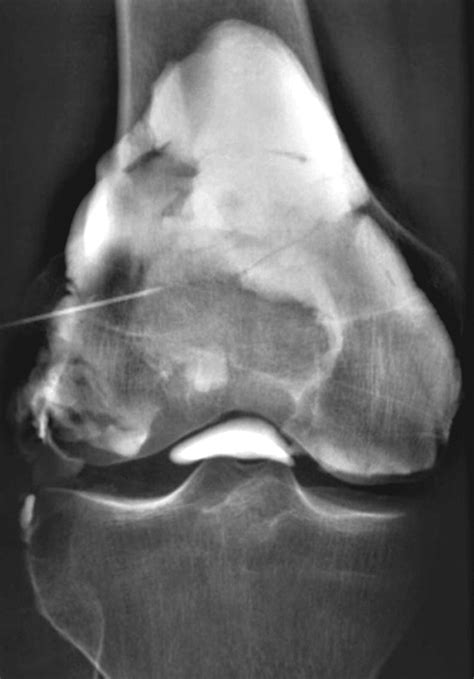Emergency Joint Aspiration A Guide For Radiologists On Callradiographics