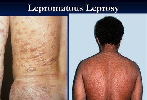 6302 Leprosy Hansens Disease Mepss Medical Epss