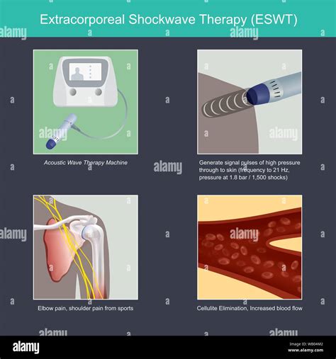 Shockwave Medical Stock Vector Images Alamy