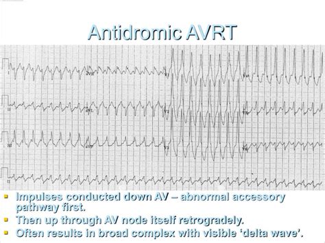 Ppt Junctional Rhythms A V Nodal Rhythm Powerpoint Presentation