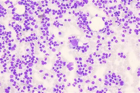 Diffuse Large B Cell Lymphoma DLBCL Hematomorphology A Databank