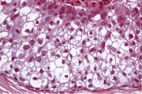 Ductal Carcinoma In Situ Dcis Oncohema Key