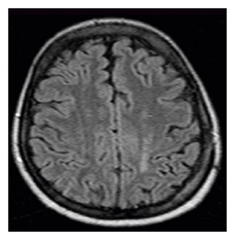 Mri Brain Scan Performed Three Months After Evacuation Of The