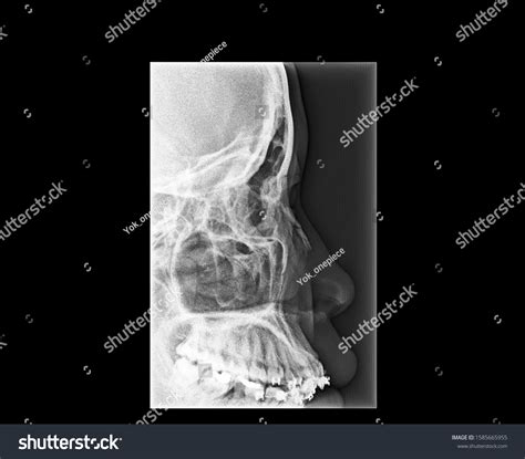Nose Bone X Ray At Clinton Spears Blog