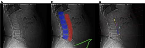 Figure 2 From Automatic Segmentation And Quantification Of Abdominal Aortic Calcification In