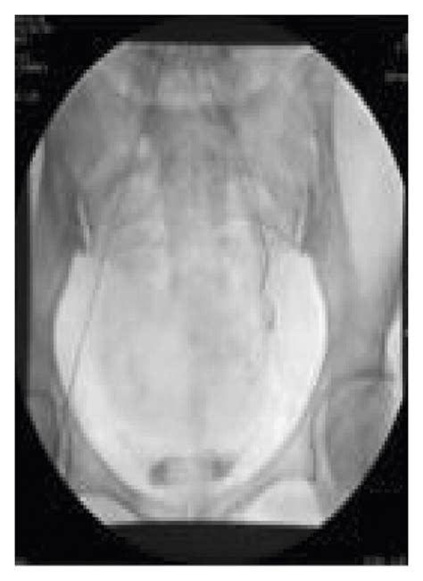 Complete Embolization Of Left Uterine Artery Download Scientific Diagram