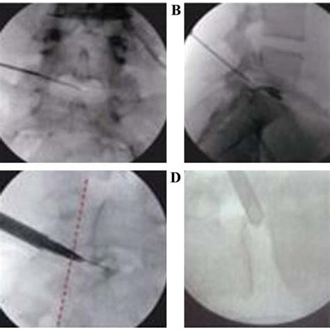 Pdf Effects Of Release And Decompression Techniques On Nerve Roots Through Percutaneous