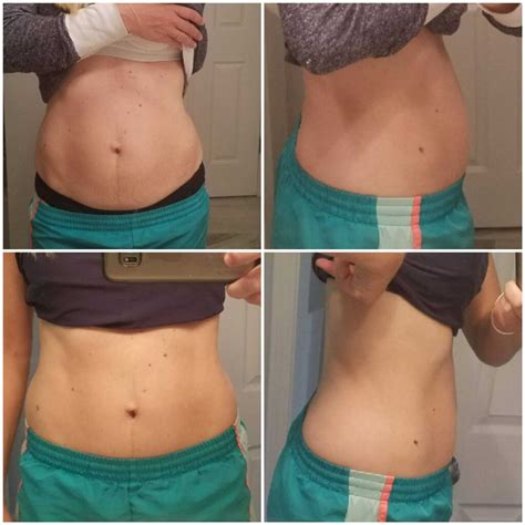 Diastasis Recti Before And After [without Surgery] Lucies List