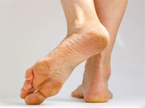 Callus Management In West Palm Beach FL Integrative Foot And Ankle