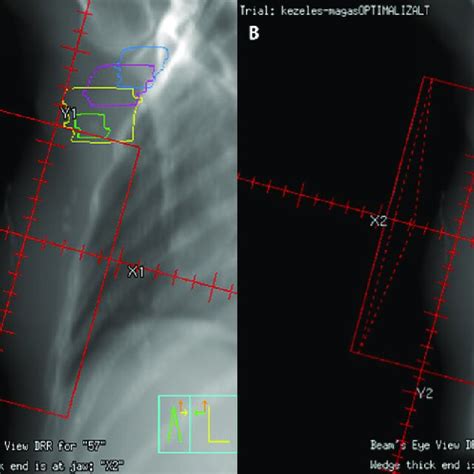 Coverage Of The Axillary Volumes With Standard A Or High B Tangent Download Scientific