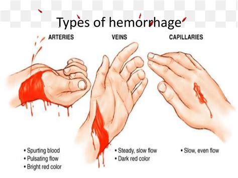 Hemorrhagepptx