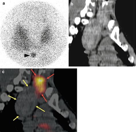 Spect Ct Imaging In Hyperparathyroidism And Benign Thyroid Disorders Radiology Key