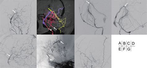 A The Right Eca Angiogram Lateral View Showing An Av Shunt Arrow Download Scientific