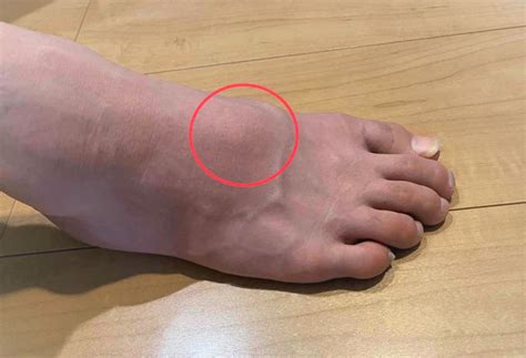 急 に 足 の 甲 が 痛い 足の甲が痛い 歩けない 足の甲の外側に痛みが！この対処法で楽になる！ Axbwfw