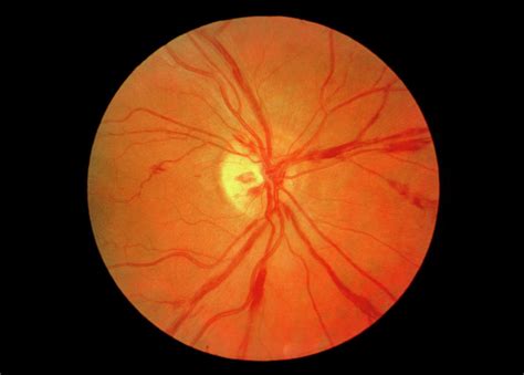 Ophthalmoscopy Of Eye Showing Retinal Vasculitis Photograph By Science