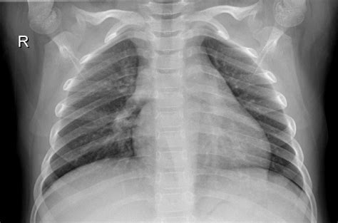 Juliensimon Autotrain Data Chest Xray Demo · Datasets At Hugging Face