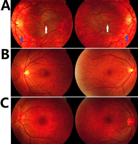 Fundi Photographs A Fundus Of The Proband V4 Revealed Severe Fundus