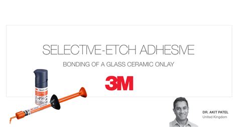 Selective Etch Adhesive Bonding Of A Glass Ceramic Onlay Henry Schein