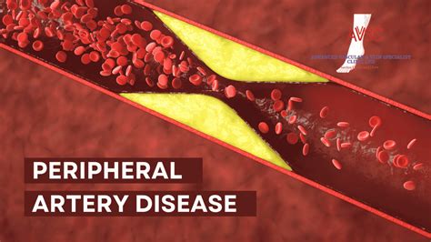 Peripheral Artery Disease Early Detection And Management Advanced