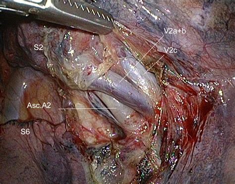 Thoracoscopic Right Apicoposterior Segmentectomy Ctsnet