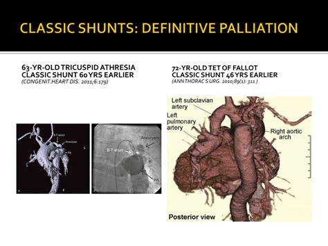 Ppt Systemic To Pulmonary Artery Shunts Powerpoint Presentation