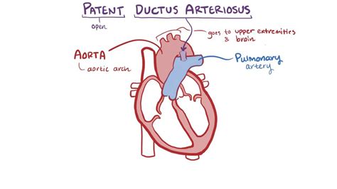 Patent Ductus Arteriosus Video Anatomy And Definition Osmosis