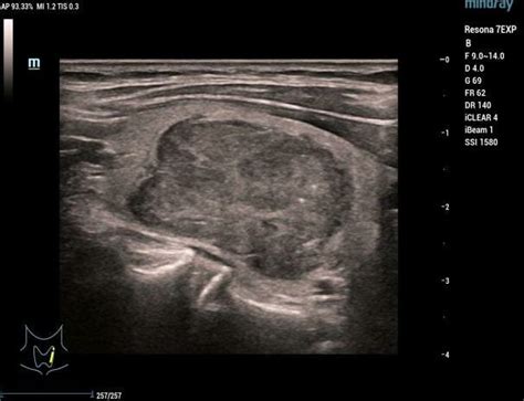 The Left Thyroid Nodule With The Maximum Diameter Of 35 Mm In A