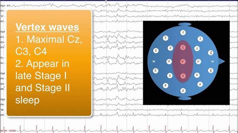 Normal Awake Eeg