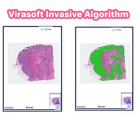 Digitalpathology Invasive Algorithm Ai Burak Uzel