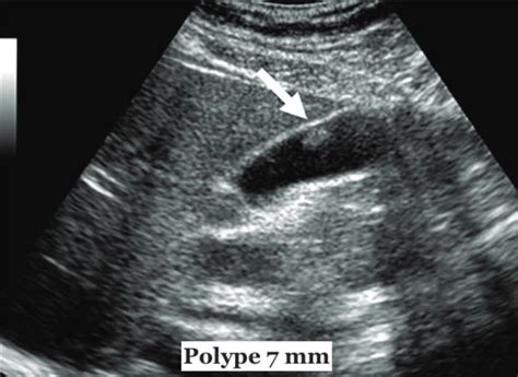 Polypes De Vésicule Biliaire Les Recommandations De La Sru