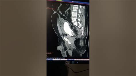 Ct Cystography Youtube