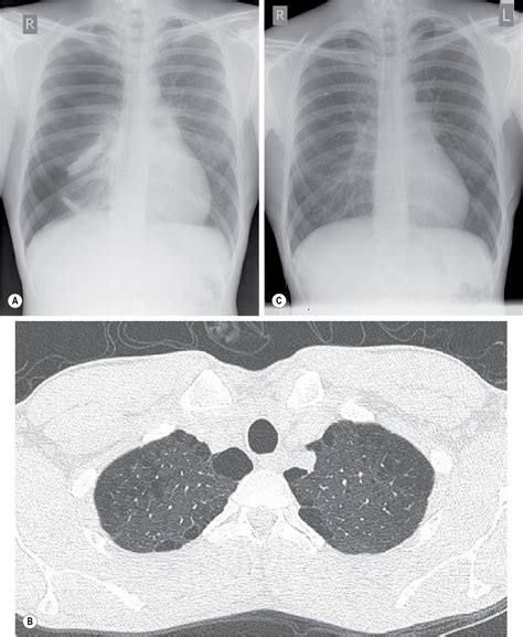 Diseases Of The Lung Parenchyma And Pleura Clinical Tree