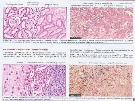 Necrosis And Gangrene Pathology Calcification Ppt