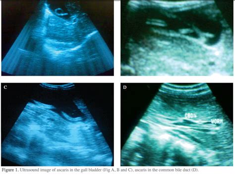 Ask Dis Gallbladder Ascariasis