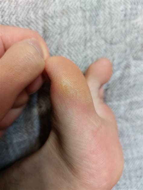 엄지 발가락 굳은살 제거법 지식in