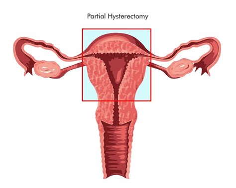 Laparoscopic Supracervical Hysterectomy Choosing The Route For Benign