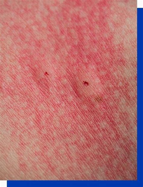 Insect Bite Swelling Treatment Best Treatment For Insect Bites
