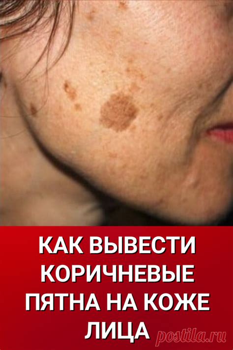 Чем можно отбелить пигментные пятна Как вывести пигментацию на лице
