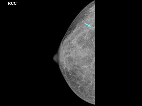 Atlas Of Breast Cancer Early Detection