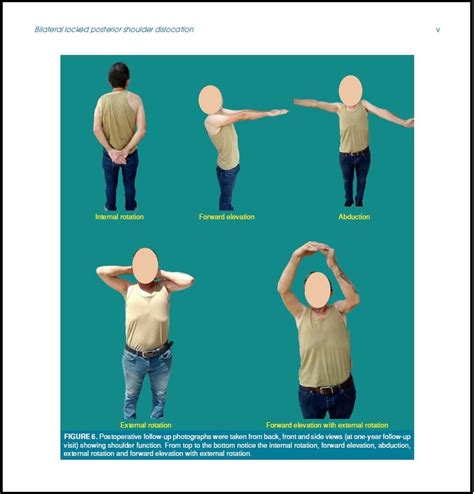 Doç Dr Murat Saylık Bilateral Locked Posterior Shoulder Dislocation Overlooked For 15 Months