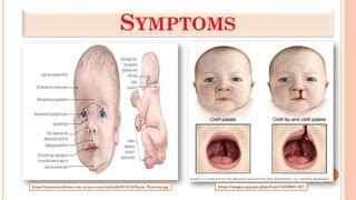 Digeorge Syndrome Dgs Pdf