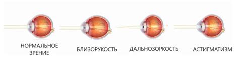 Астигматизм Что это такое простыми словами лечение и симптомы